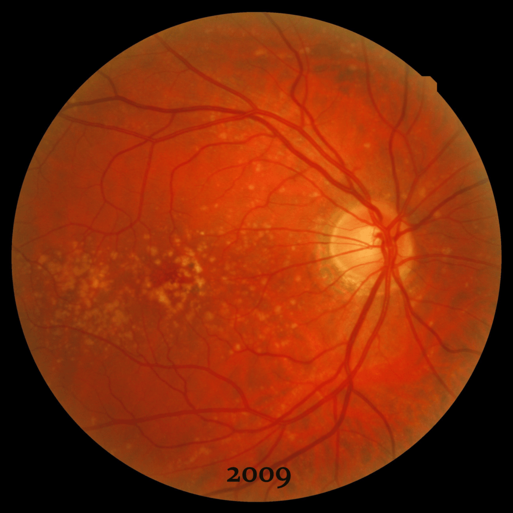 Macular Macular